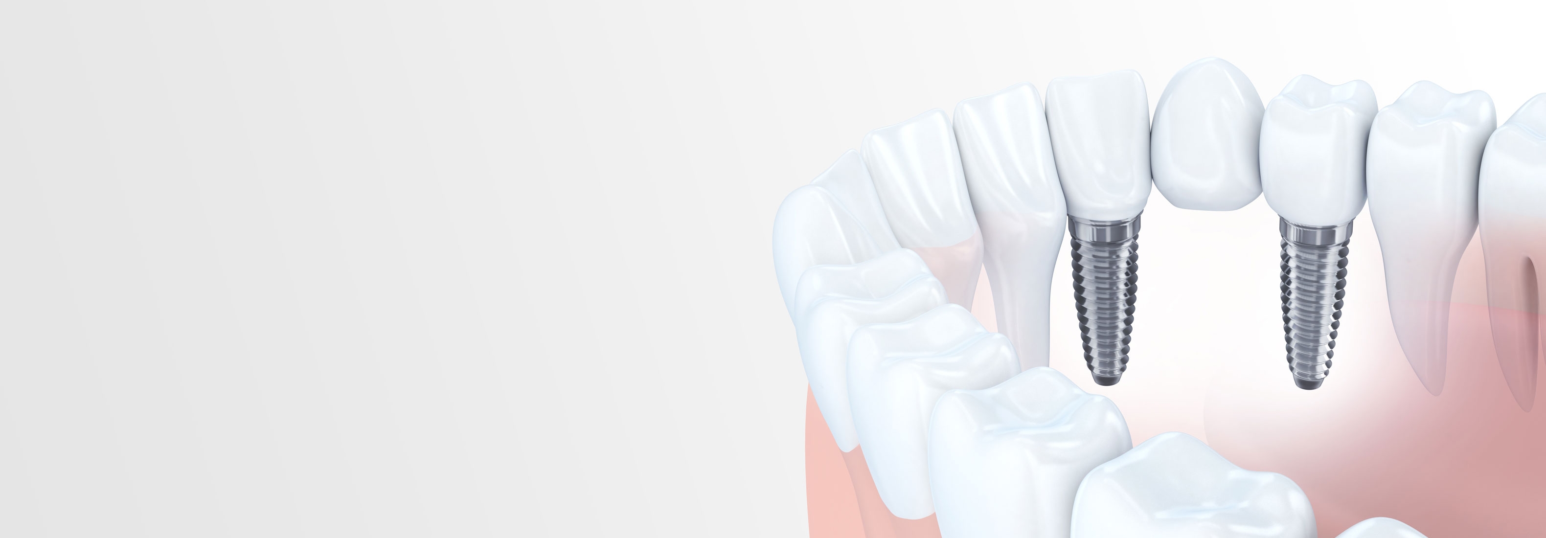 Essix Retainer With Pontics